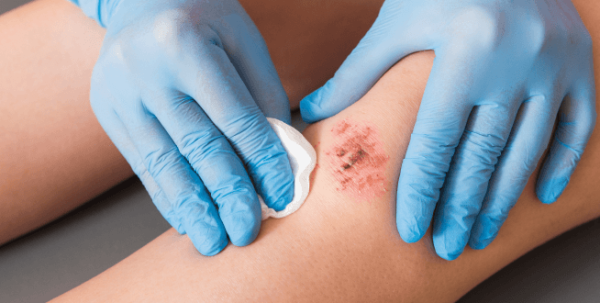 CURACIÓN DE HERIDAS WORKSHOP – Cemedip